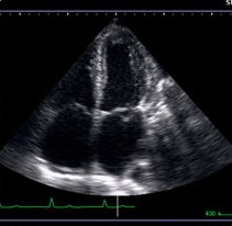 Echocardiogram