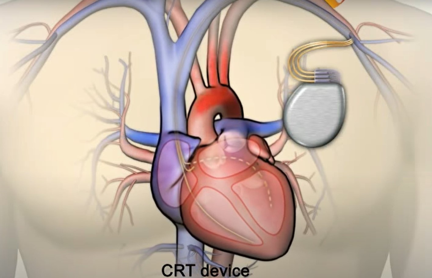 La resynchronisation cardiaque (CRT) - Heart Failure Matters